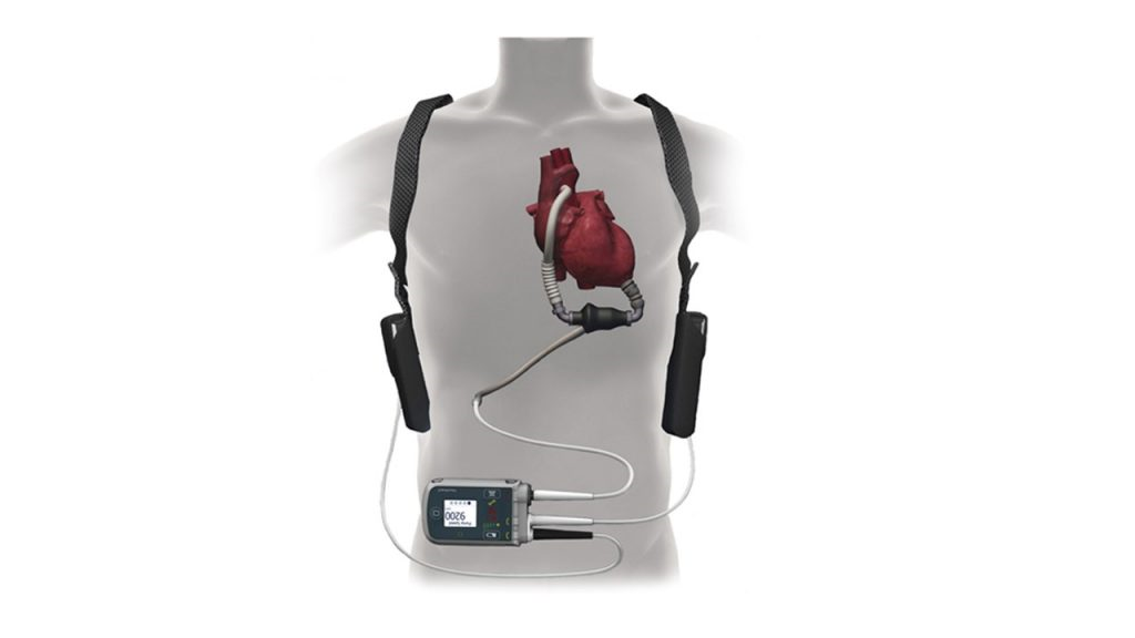 lvad-1024×576 | WVU Heart and Vascular Institute