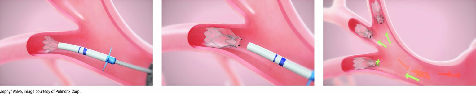 Zephyr® Endobronchial Valve Procedure for Severe COPD/Emphysema Thomas ...