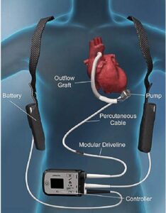 Left Ventricular Assist Device (LVAD) | WVU Heart & Vascular Institute